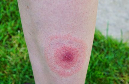 5 Common Summer Rashes and How to Prevent Them | Hartford HealthCare | CT