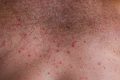 5 Common Summer Rashes and How to Prevent Them - Health News Hub