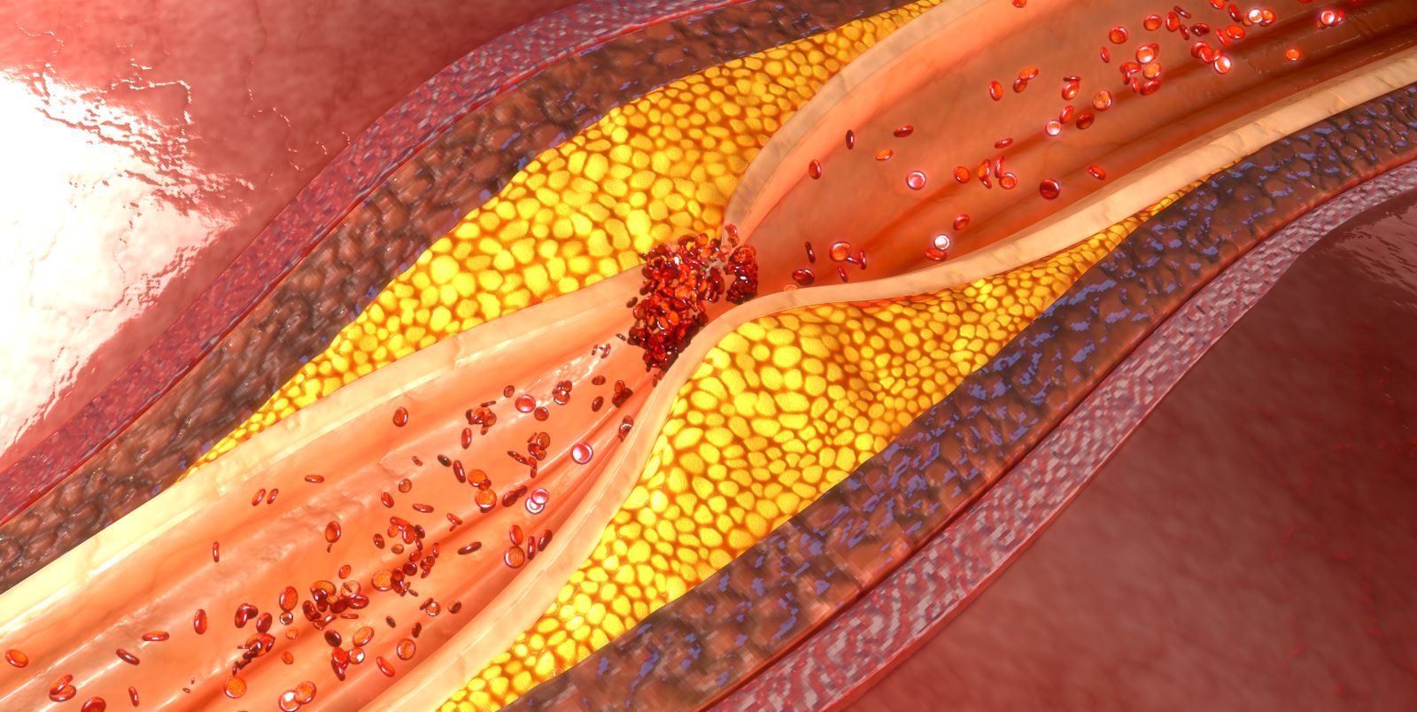 Have High Cholesterol A Simple Test Can Show If You Actually Need A Have High Cholesterol A Simple Test Can Show If You Actually Need A