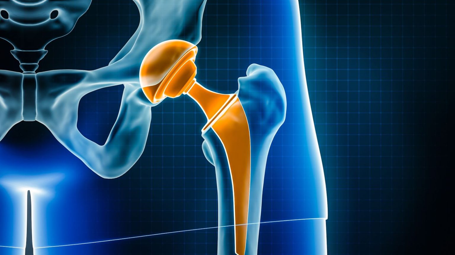 Which Type of Hip Replacement Is Right for Me? - Health News Hub